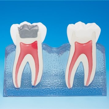 Tandmodel - fraktureret tand