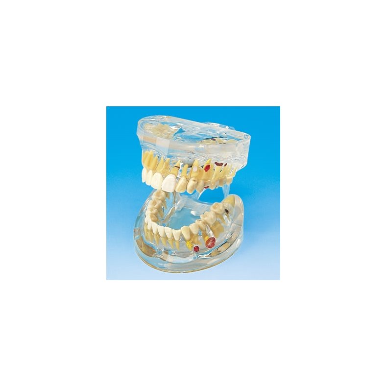 Transparent Sygdomsmodel - Patientundervisning - Dentalinstituttet