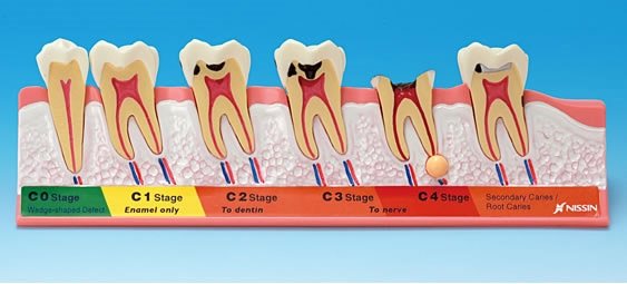Dental model showing caries development